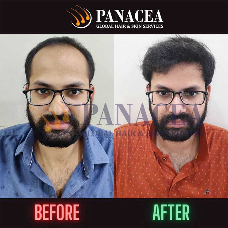 Hair Transplant Before and After Result - Panacea Global Hair & Skin ...