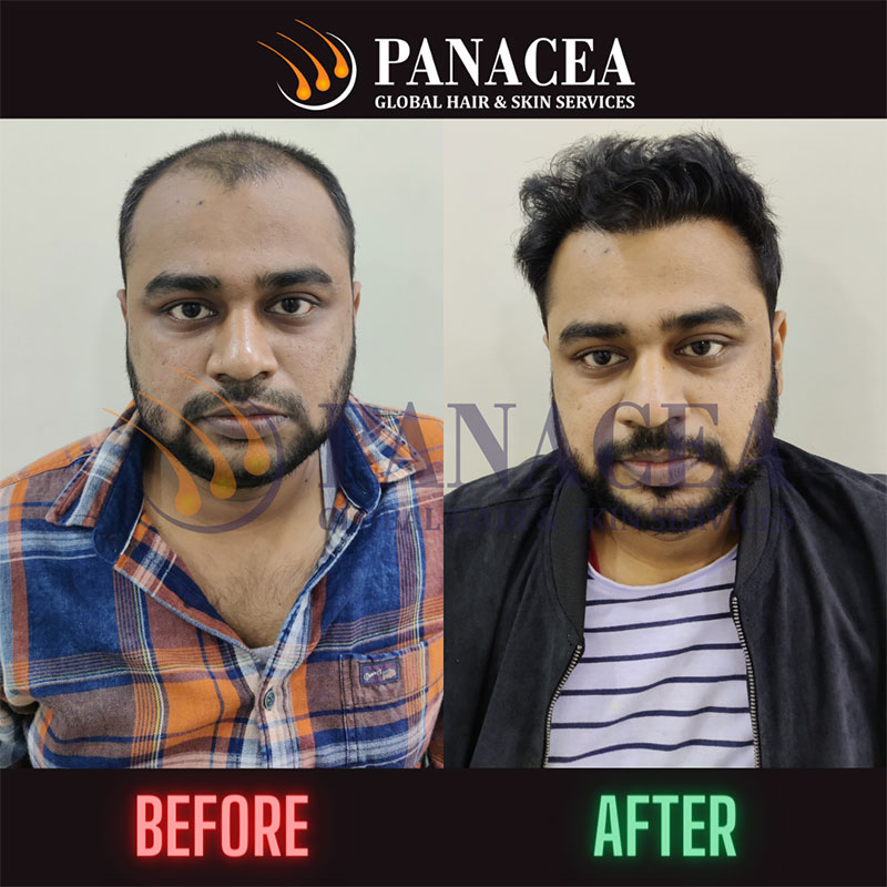 Hair Transplant Before and After Result - Panacea Global Hair & Skin ...