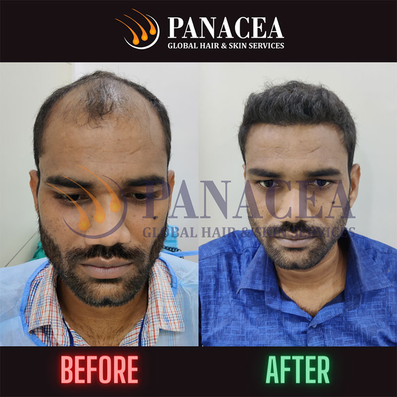 Hair Transplant Before and After Result - Panacea Global Hair & Skin ...