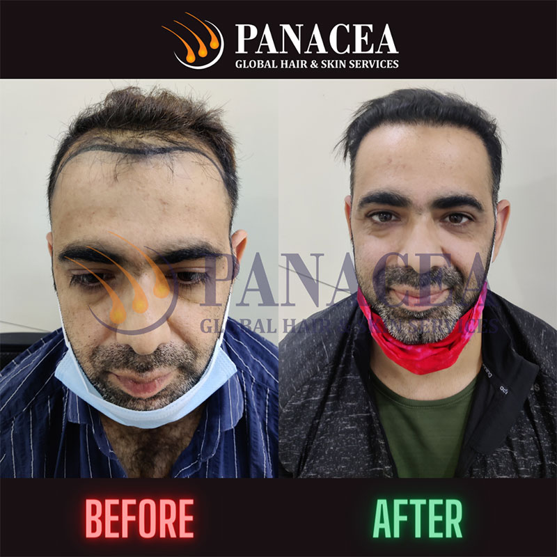 Hair Transplant Before and After Result - Panacea Global Hair & Skin ...