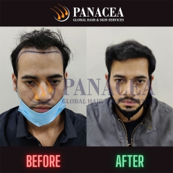 Hair Transplant Before and After Result - Panacea Global Hair & Skin ...