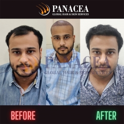 Hair Transplant Before and After Result - Panacea Global Hair & Skin ...